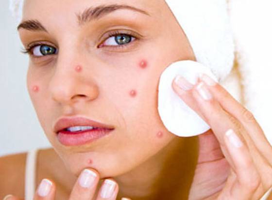 Hard Water and Acne | How Hard Water Effects Your Face and Skin